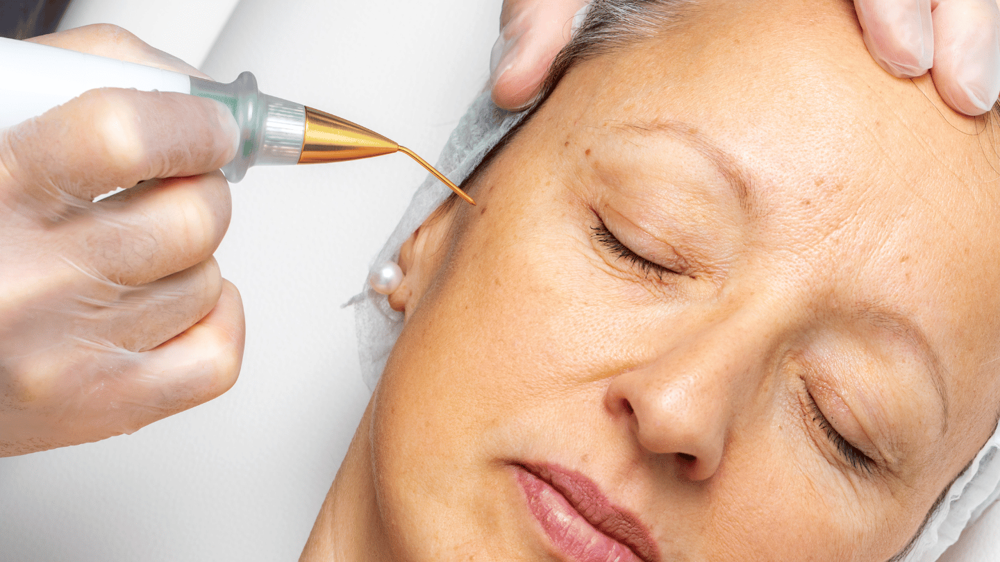 Fibromen (steelwratjes) weghalen met slechts één behandeling